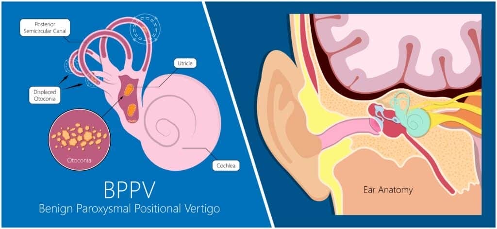 Benign Paroxysmal Positional Vertigo (BPPV) Treatment | Good Shepherd ...